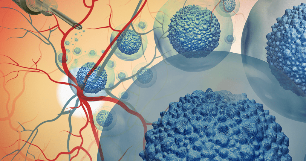 Stem Cell-Engineered Implant for Geographic Atrophy Shows Promise, Long ...
